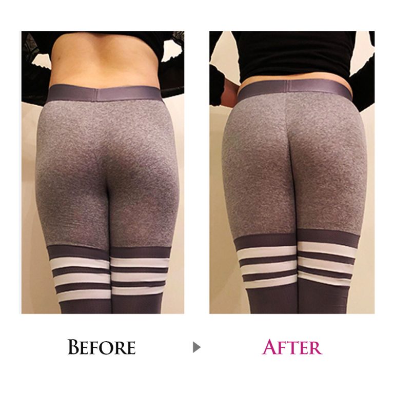 Before After - PeachUp（ピーチアップ）お尻専門スタジオ｜美尻＆桃尻専門ヒップトレーニング ジム ｜銀座